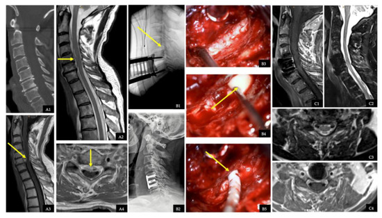 Diagnostics, Management, and Outcomes in Patients with Pyogenic Spinal ...