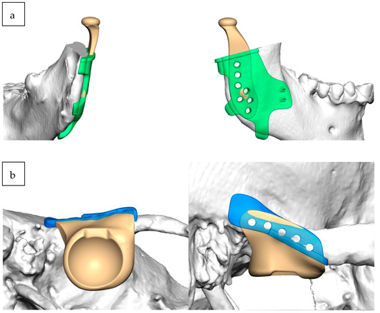 JCM | Free Full-Text | Temporomandibular Joint Prosthesis in a Patient ...
