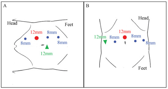 Efficacy of Robot-Assisted Ureteroureterostomy in Patients with Complex Ureteral Stricture after ...