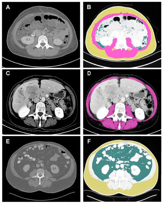 JCM | Free Full-Text | Impact of Altered Body Composition on Clinical ...