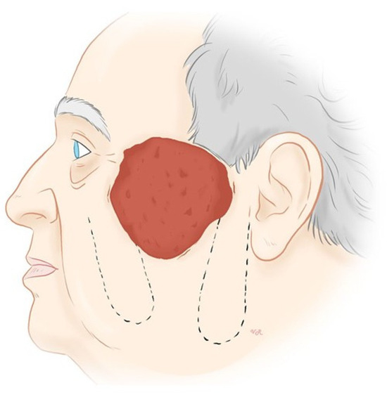 A Novel Approach to the Reconstruction of a Large Surgical Defect in ...