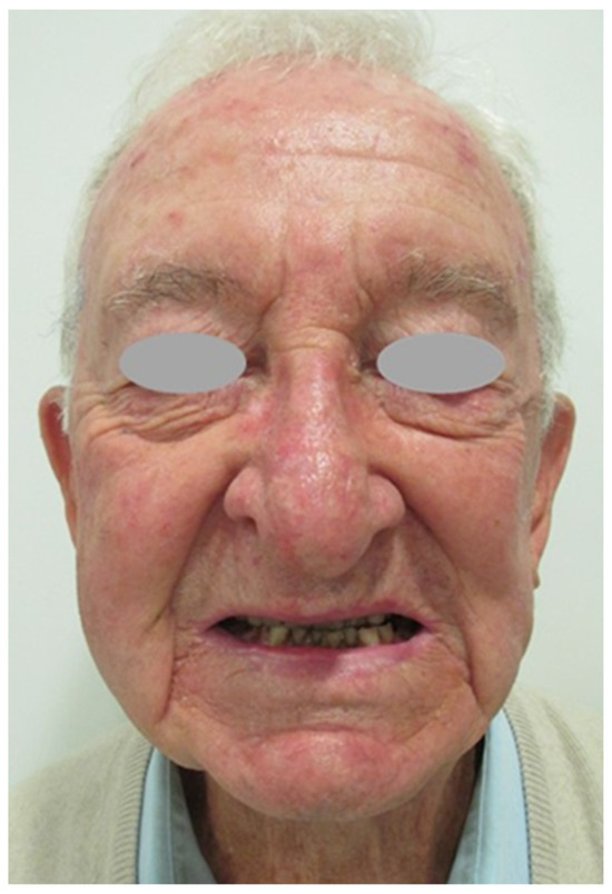 A Novel Approach to the Reconstruction of a Large Surgical Defect in ...