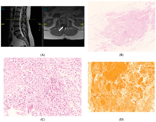 The Surgical Histopathology of the Filum Terminale: Findings from a ...