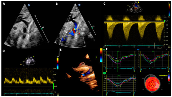 Non-Invasive Imaging Assessment in Patients with Aortic Coarctation: A ...
