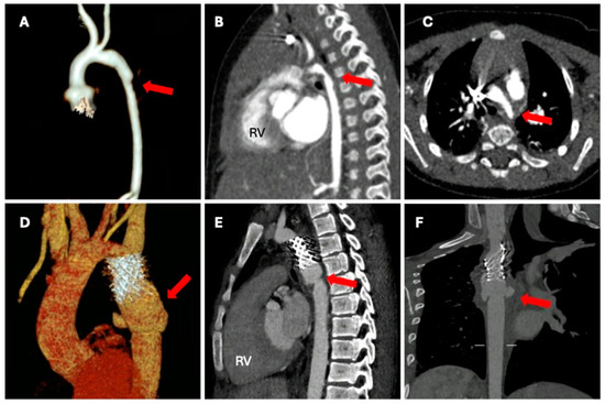 Non-Invasive Imaging Assessment in Patients with Aortic Coarctation: A ...