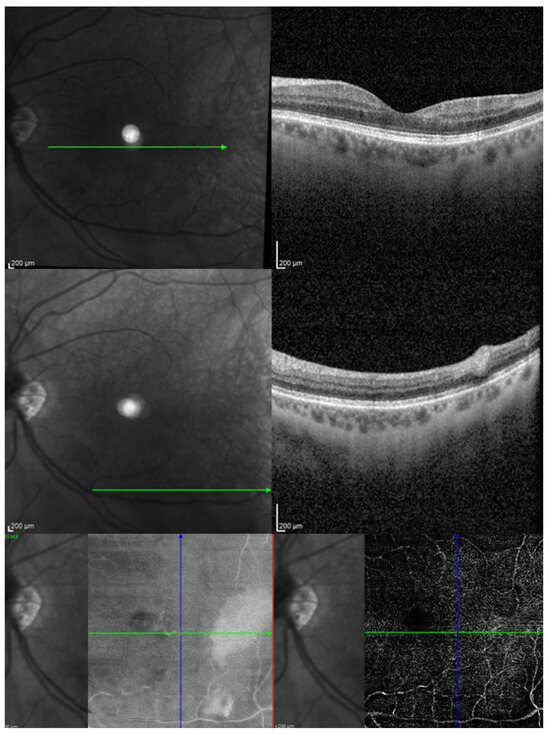 Hyperbaric Oxygen Therapy in Ophthalmology: A Narrative Review