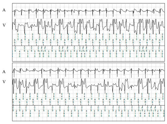 Catecholaminergic Polymorphic Ventricular Tachycardia: Multiple ...