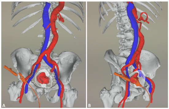Jcm Free Full Text Prostate Artery Embolization In The Treatment Of