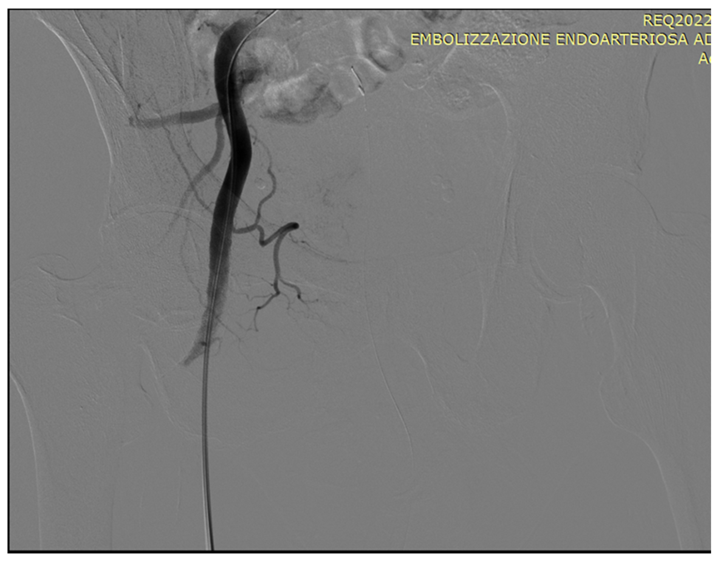 Jcm Free Full Text Prostate Artery Embolization In The Treatment Of