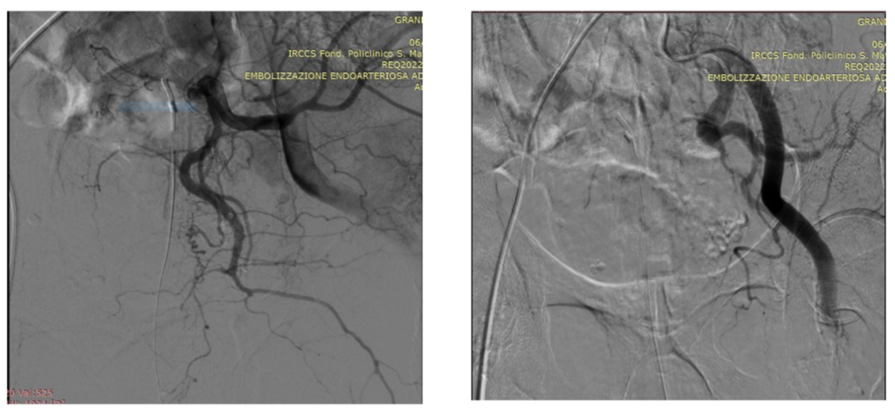 Jcm Free Full Text Prostate Artery Embolization In The Treatment Of