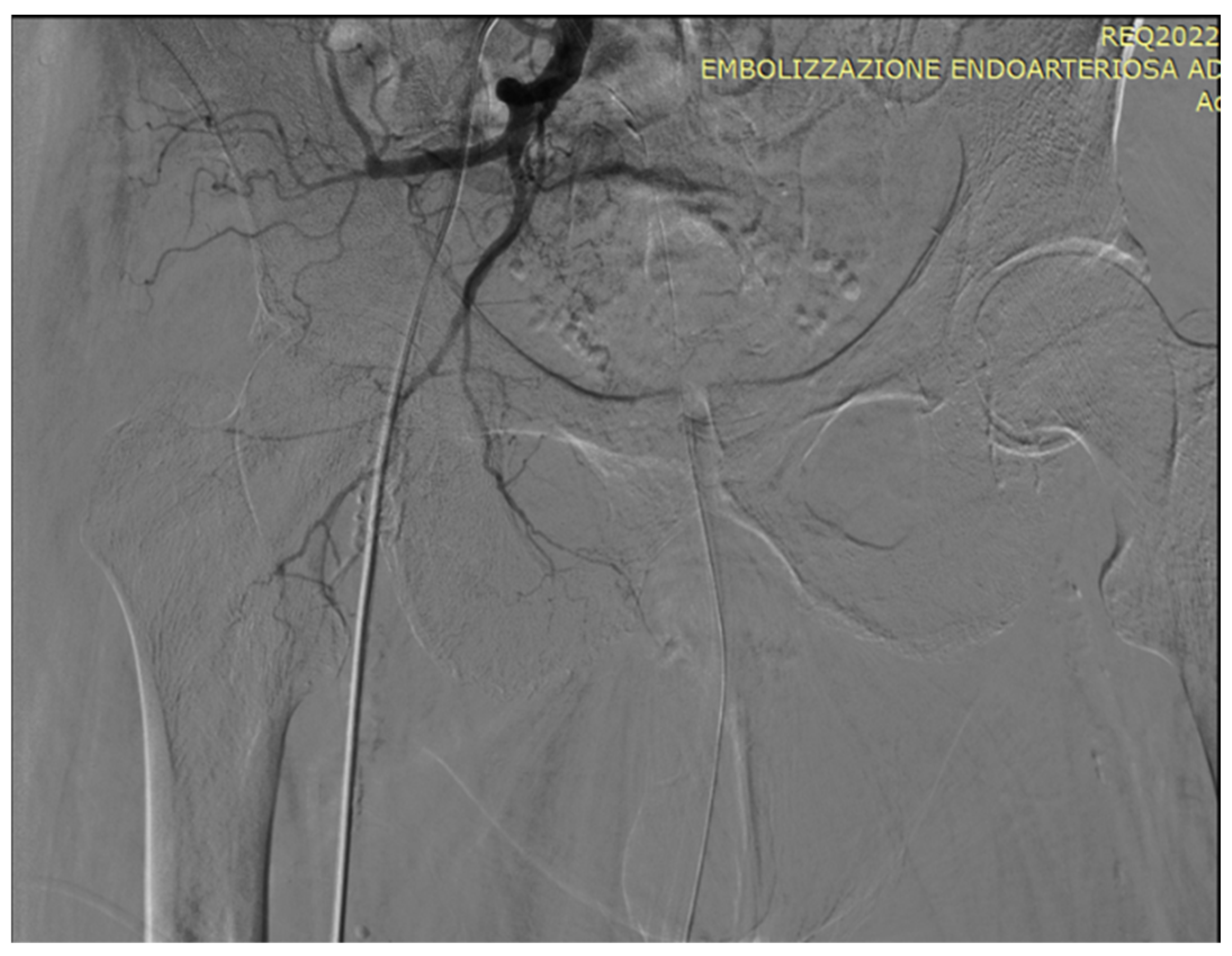 Jcm Free Full Text Prostate Artery Embolization In The Treatment Of