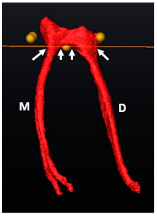 A New Methodology to Determine the Orifice for Root Canal ...