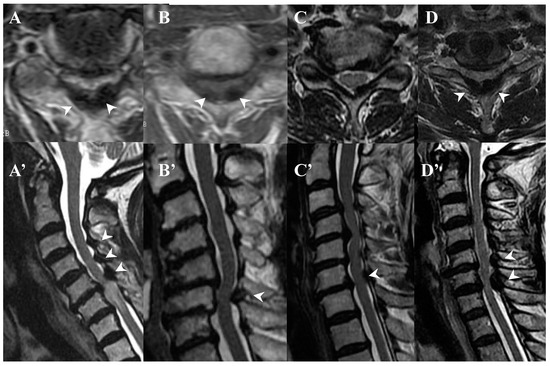 The Symptomatic Calcification and Ossification of the Ligamentum Flavum ...