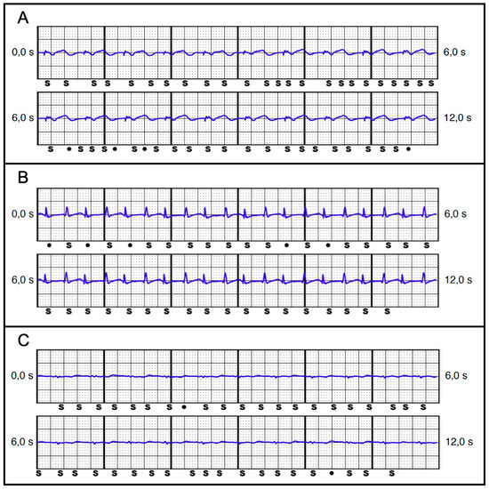 Safety and Performance of the Subcutaneous Implantable Cardioverter ...