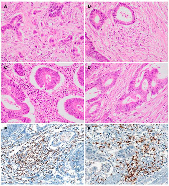 Prognostic Implications of Intratumoral Budding in Colorectal Cancer ...