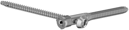 Stabilization of Traumatic Iliosacral Instability Using Innovative ...