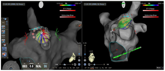 Atrial Fibrillation Ablation with a Novel Fully 3D-Mapping-Integrated ...