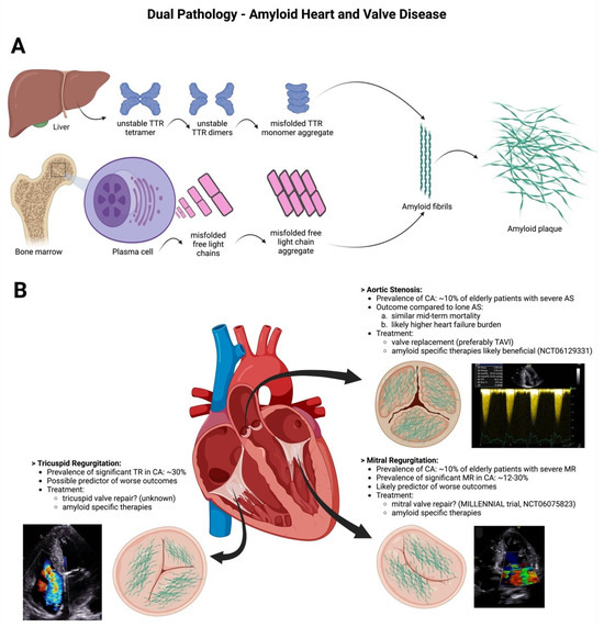 Cardiac Amyloidosis and Valvular Heart Disease