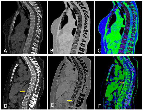 Imaging of Multiple Myeloma: Present and Future
