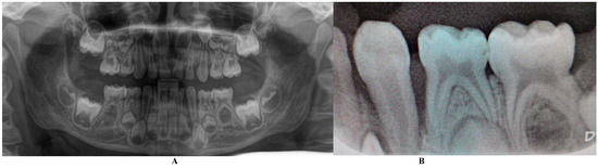 Case Report of a 4-Year-Old Girl with Stage IV Grade C Localized ...