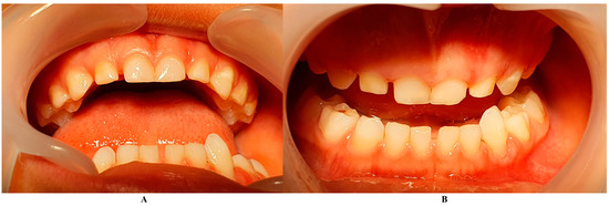 Case Report of a 4-Year-Old Girl with Stage IV Grade C Localized ...