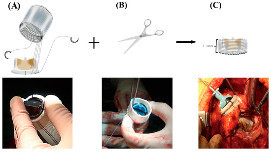 Early and Mid-Term Outcomes of Using the Chimney Technique in Redo ...