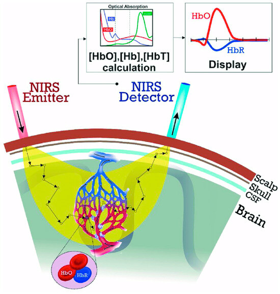 Functional Near-Infrared Spectrometry as a Useful Diagnostic Tool for Understanding the Visual ...