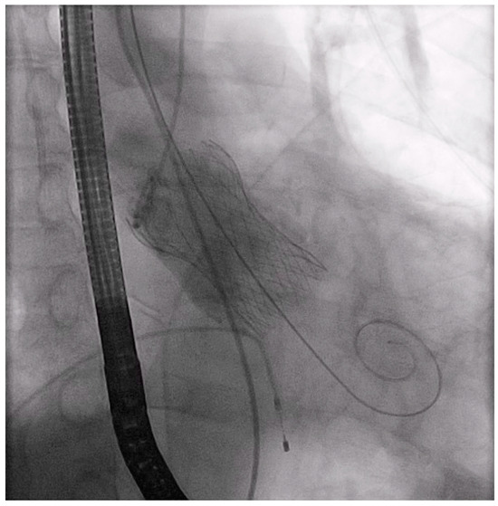 Trans-Brachial TAVI in a Patient with Aortic Isthmus Stenosis: A Case ...