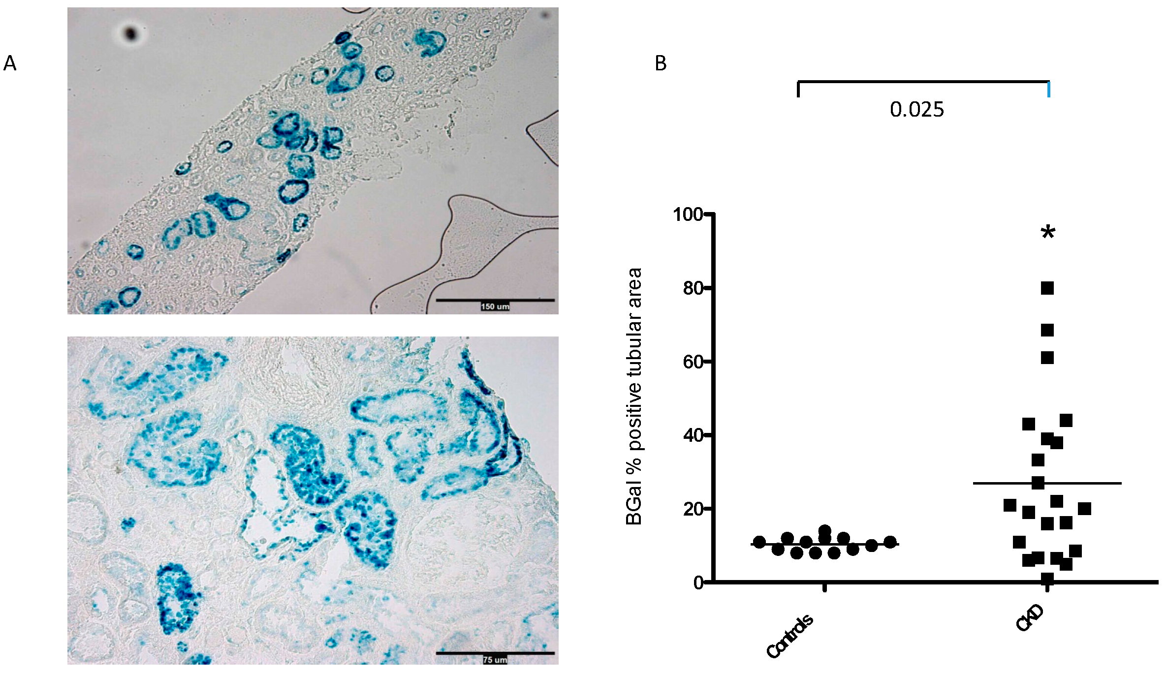 SA-β-Gal in Kidney Tubules as a Predictor of Renal Outcome in Patients ...