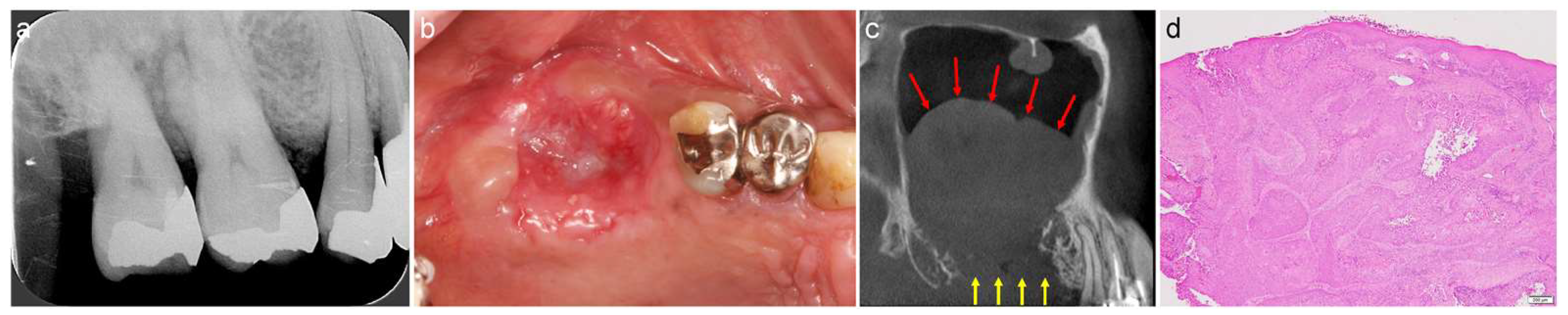 A Comprehensive Clinical Review of Maxillary Sinus Floor Elevation in Patients with Well-Defined ...
