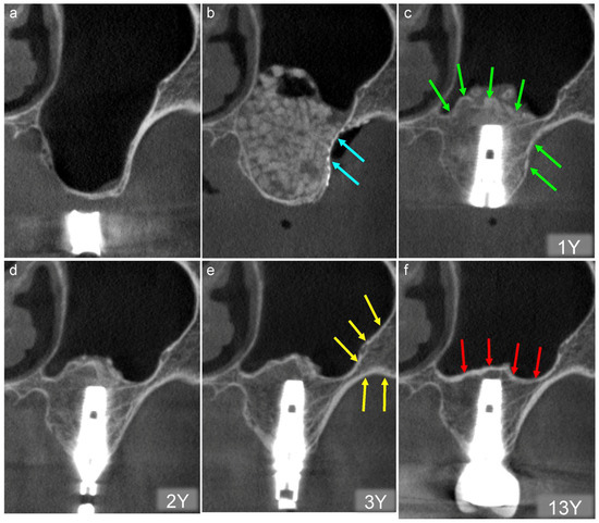 A Comprehensive Clinical Review of Maxillary Sinus Floor Elevation in Patients with Well-Defined ...