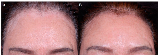 Clinical Efficacy of 5-Fluorouracil and Bleomycin in Dermatology