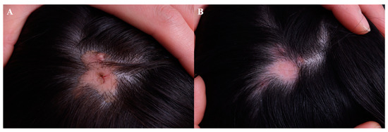 Clinical Efficacy of 5-Fluorouracil and Bleomycin in Dermatology