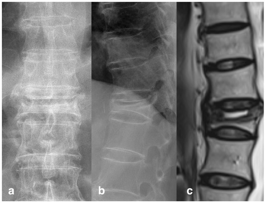 Assessment of Cement Leakage in Decompressed Percutaneous Kyphoplasty