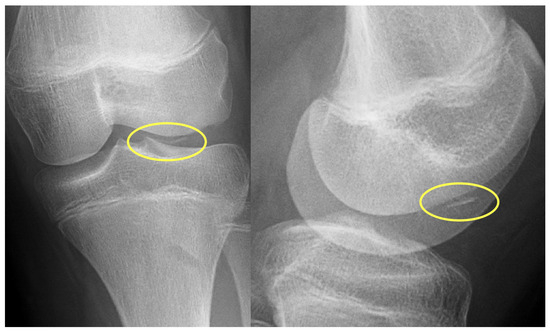 JCM | Free Full-Text | Management of Juvenile Osteochondral Fractures Utilising Absorbable PLGA ...
