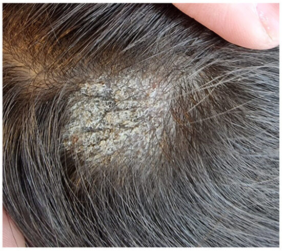 A Current Diagnostic and Therapeutic Challenge: Tinea Capitis