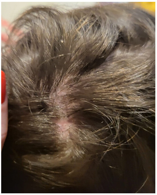 A Current Diagnostic and Therapeutic Challenge: Tinea Capitis