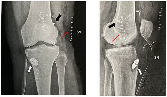 Lateral Extra-Articular Tenodesis with Indirect Femoral Fixation Using ...
