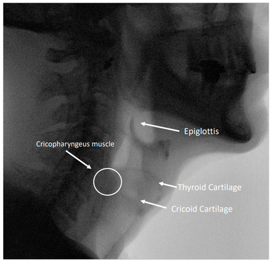 Retrograde Cricopharyngeal Dysfunction: A Review