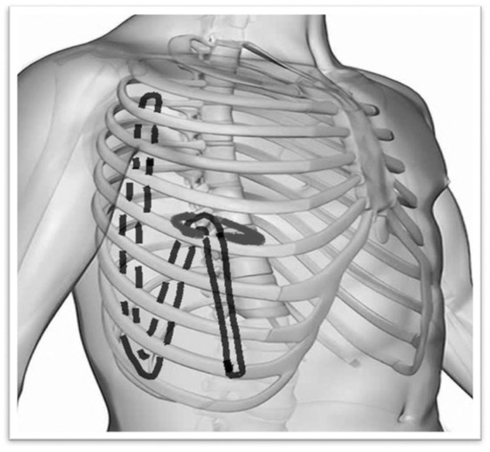 Are the Efficacy and Safety of Chest Tubes in Uniportal Video-Assisted ...