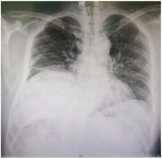 Perioperative Diaphragm Dysfunction