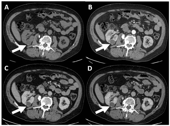 Scientific Status Quo of Small Renal Lesions: Diagnostic Assessment and ...