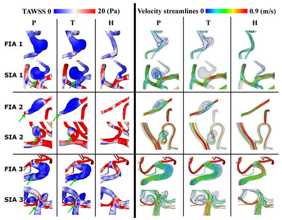 Fusiform versus Saccular Intracranial Aneurysms—Hemodynamic Evaluation ...