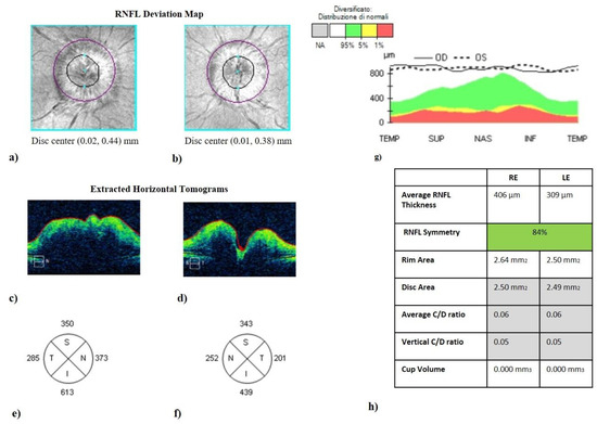 Optic Nerve Head and Retinal Changes in Idiopathic Intracranial ...