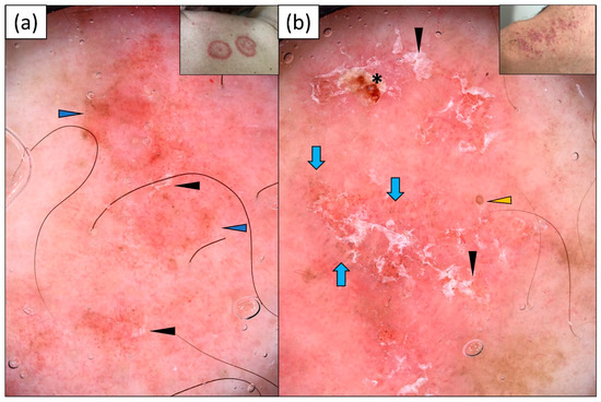 Dermoscopy for the Differentiation of Subacute Cutaneous Lupus ...