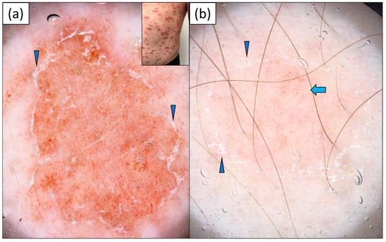 Dermoscopy for the Differentiation of Subacute Cutaneous Lupus ...