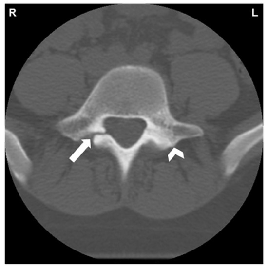 Pars Interarticularis Fractures Treated with Minimally Invasive Surgery ...
