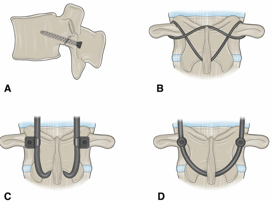 Pars Interarticularis Fractures Treated with Minimally Invasive Surgery ...