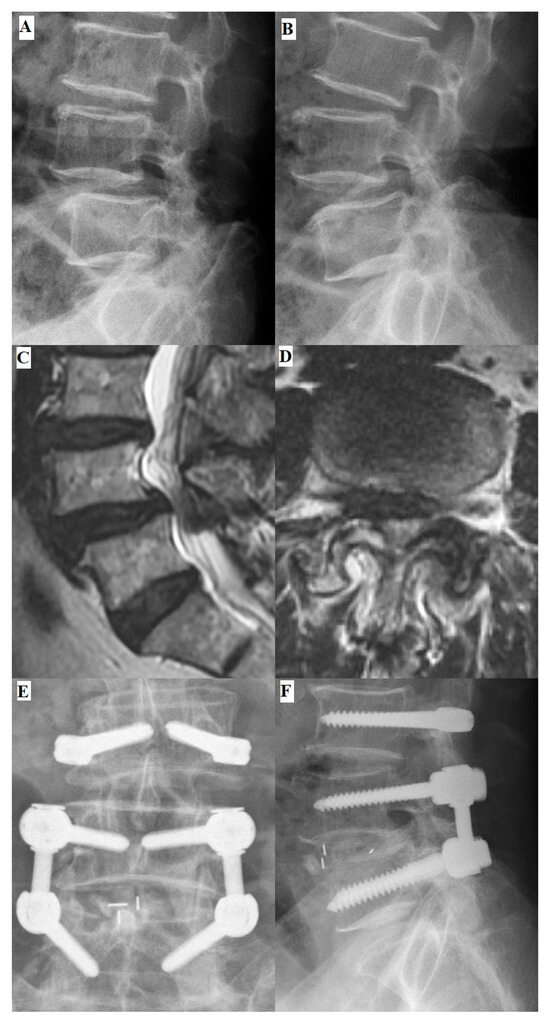 A Retrospective Observational Study to Evaluate Adjacent Segmental Degenerative Change with the ...