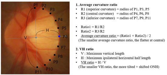 Optic Nerve Head Curvature Flattening Is Associated with Central Visual ...